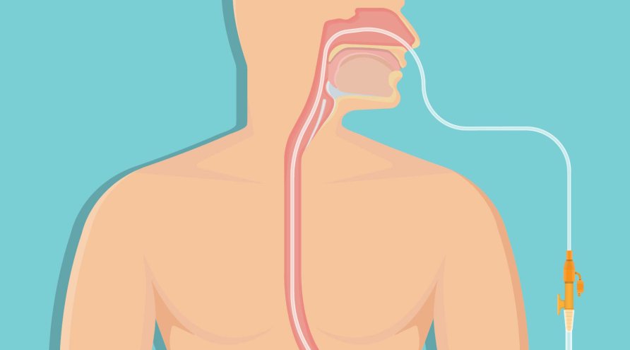 Control Methods for Placement of Nasogastric Feeding Tubes - Ukom